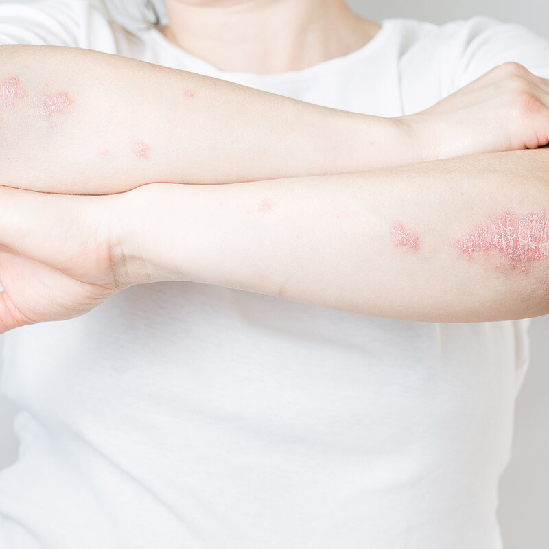 Psorijaza - uzroci, karakteristike i terapijski pristup | BENU.RS
